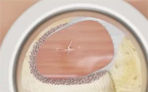 DuraStat – A Breakthrough Device for Dural Repair