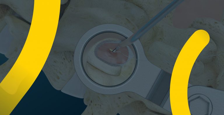 DuraStat – A Breakthrough Device for Dural Repair